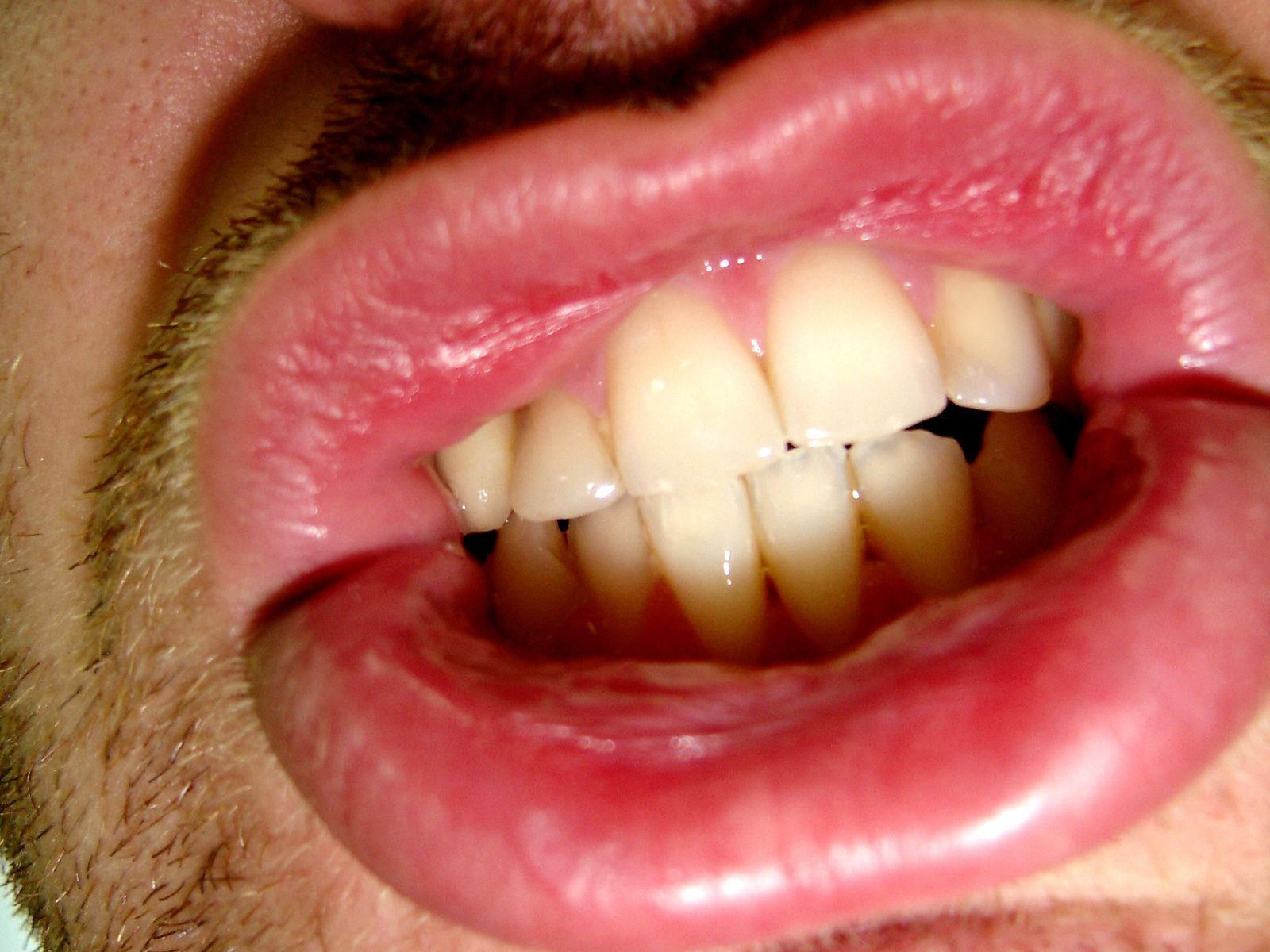 Gum Disease And Its Three Stages